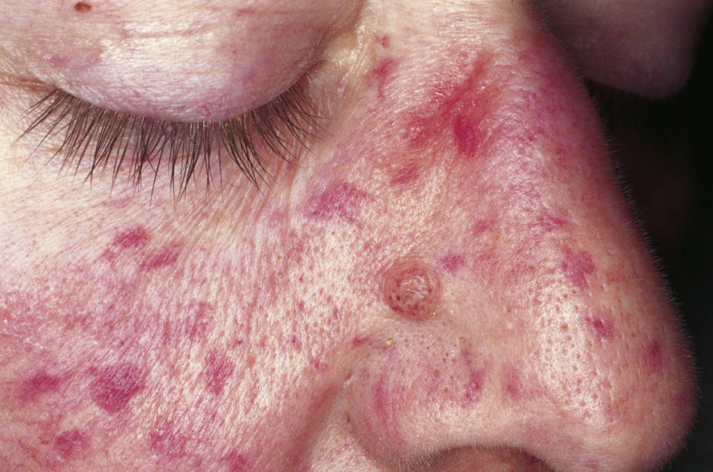 Rosto Com Telangiectasia Telangiectasia Of The Facial Skin And Lips In